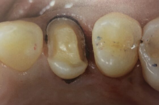 デジタル歯科の治療内容はどうするの？小さなむし歯編（インレー、アンレー）